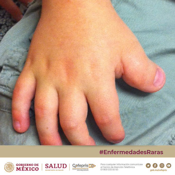 ¿A quién afecta la enfermedad de los dedos gordos o Síndrome de ...