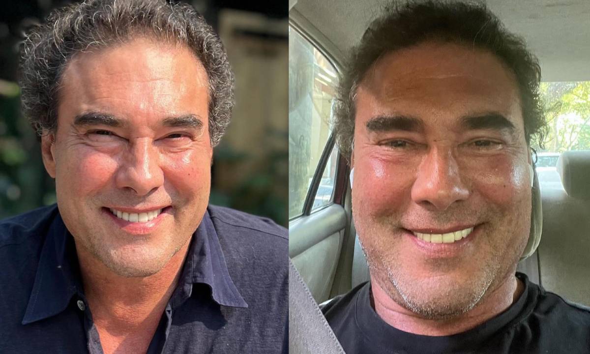 Actor Eduardo Yáñez se realiza cirugía de rejuvenecimiento facial y su ...