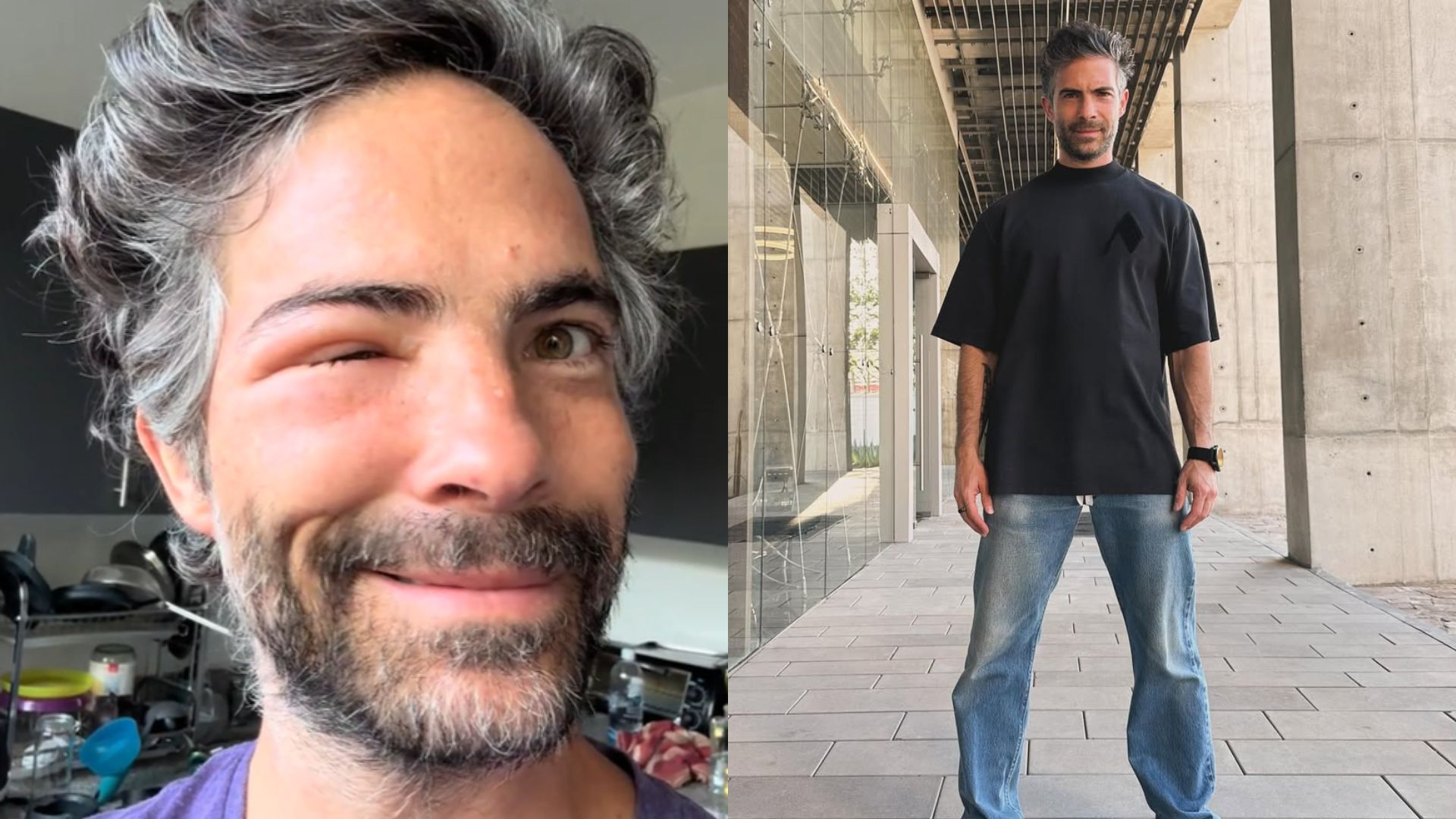 ¿Qué le pasó a Osvaldo Benavides en la cara? El actor apareció en redes ...