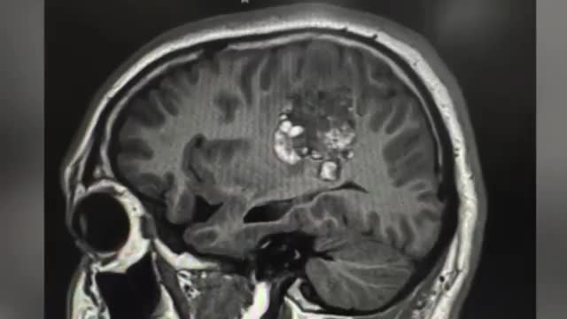 Realizan la primera cirugía cerebral con un paciente consciente