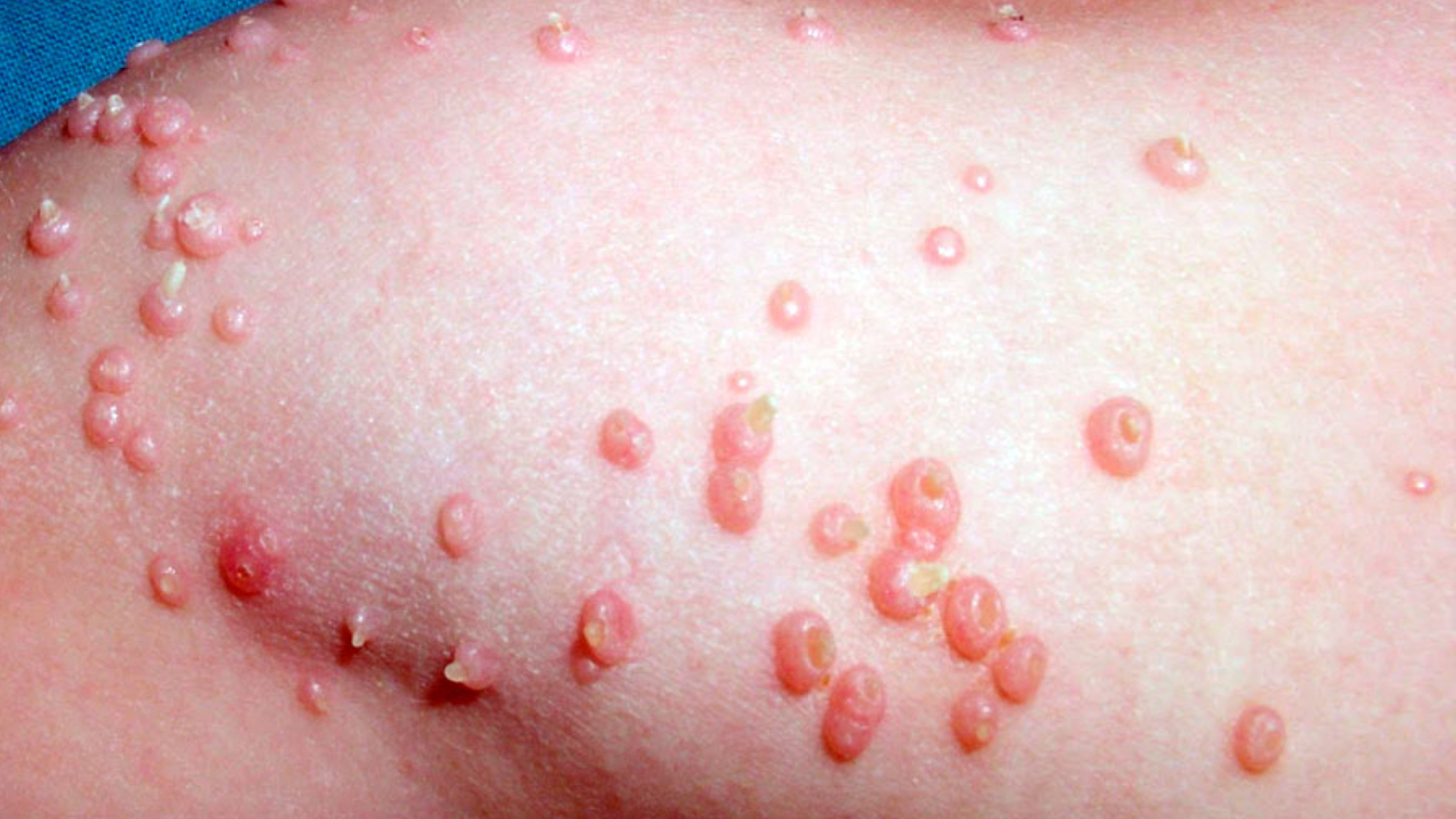 Molusco Contagioso: Qué es, cómo se transmite, síntomas y tratamiento ...