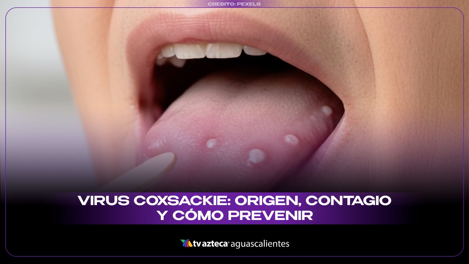 Virus Coxsackie: ¿Cuál es el origen y cómo prevenir contagios de esta ...