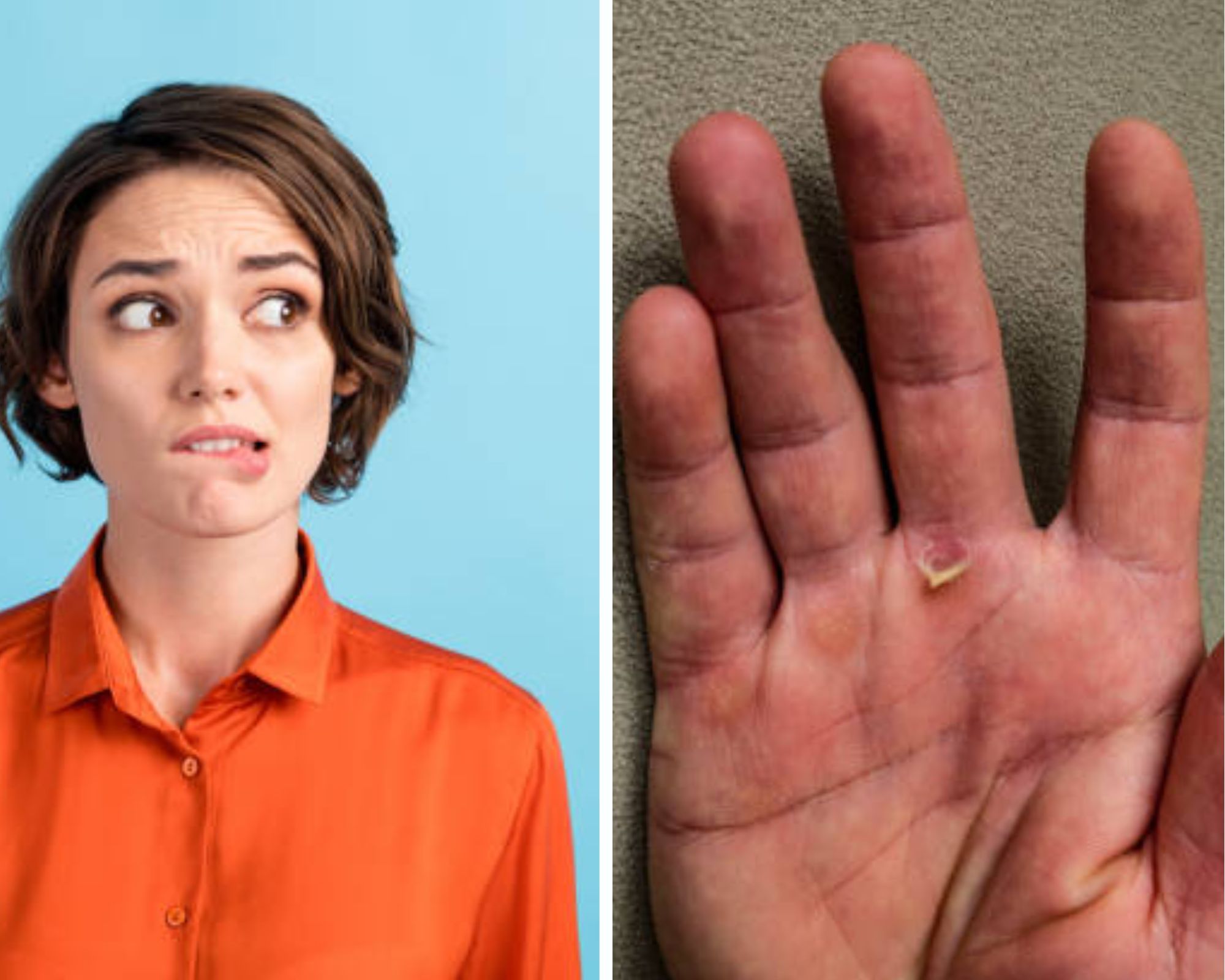 Tus callos de las manos desaparecerán para siempre si aplicas los ...