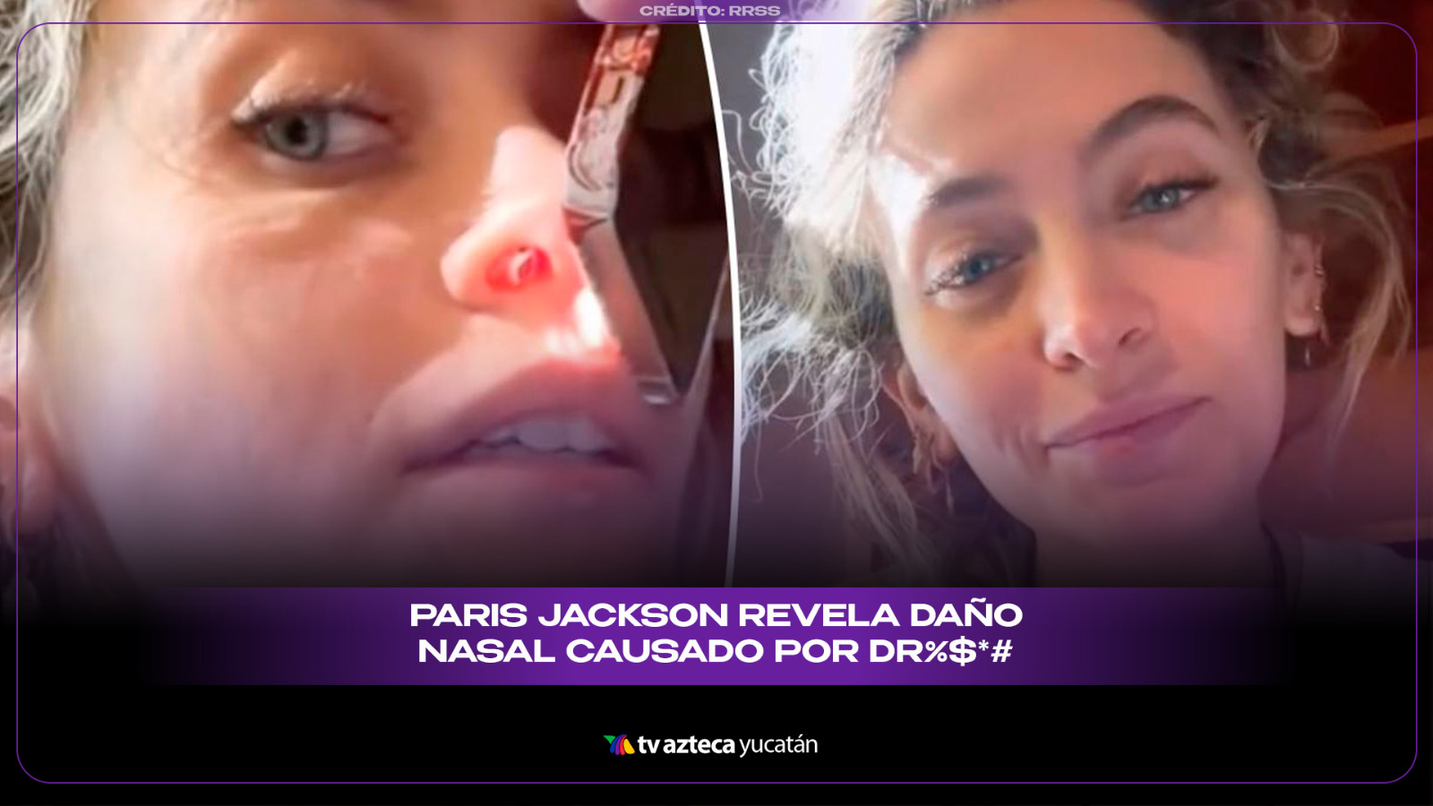 Hija de Michael Jackson muestra hueco en su nariz por consumo de drogas