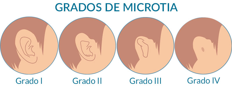 ¿Sabes que es la Microtia Atresia Bilateral?