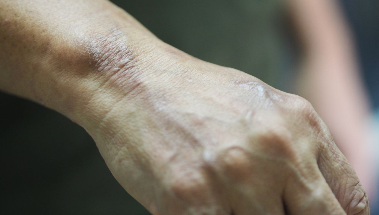 Lepra en México: estados y municipios del país afectados; qué es y síntomas