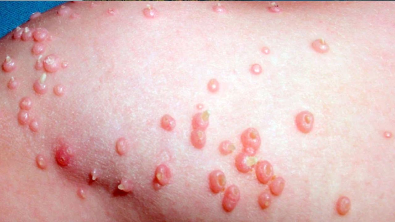 ¿Conoces el Molusco Contagioso?: Infección, síntomas y tratamiento