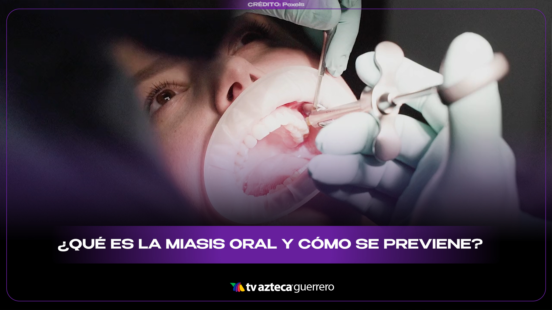 ¿Qué es la miasis oral?: Te contamos como puedes prevenirla