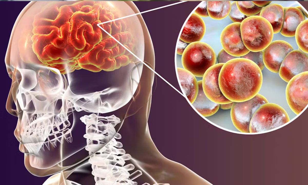 ¿Qué es la MENINGITIS? ¿Cómo se contagia? y ¿Cuál es su tratamiento?