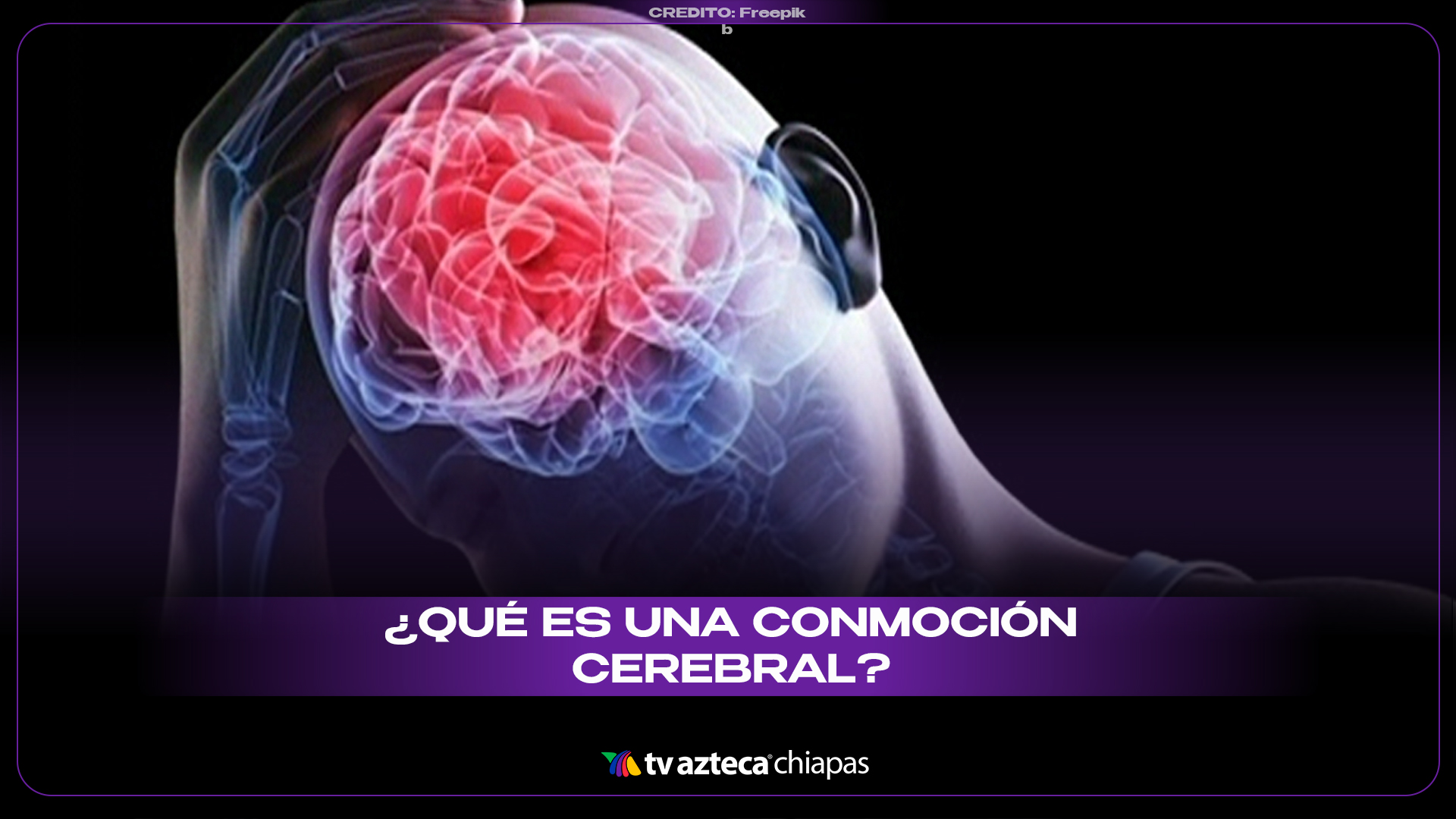 ¿Qué es una conmoción cerebral y sus síntomas?: el caso de Tom Holland