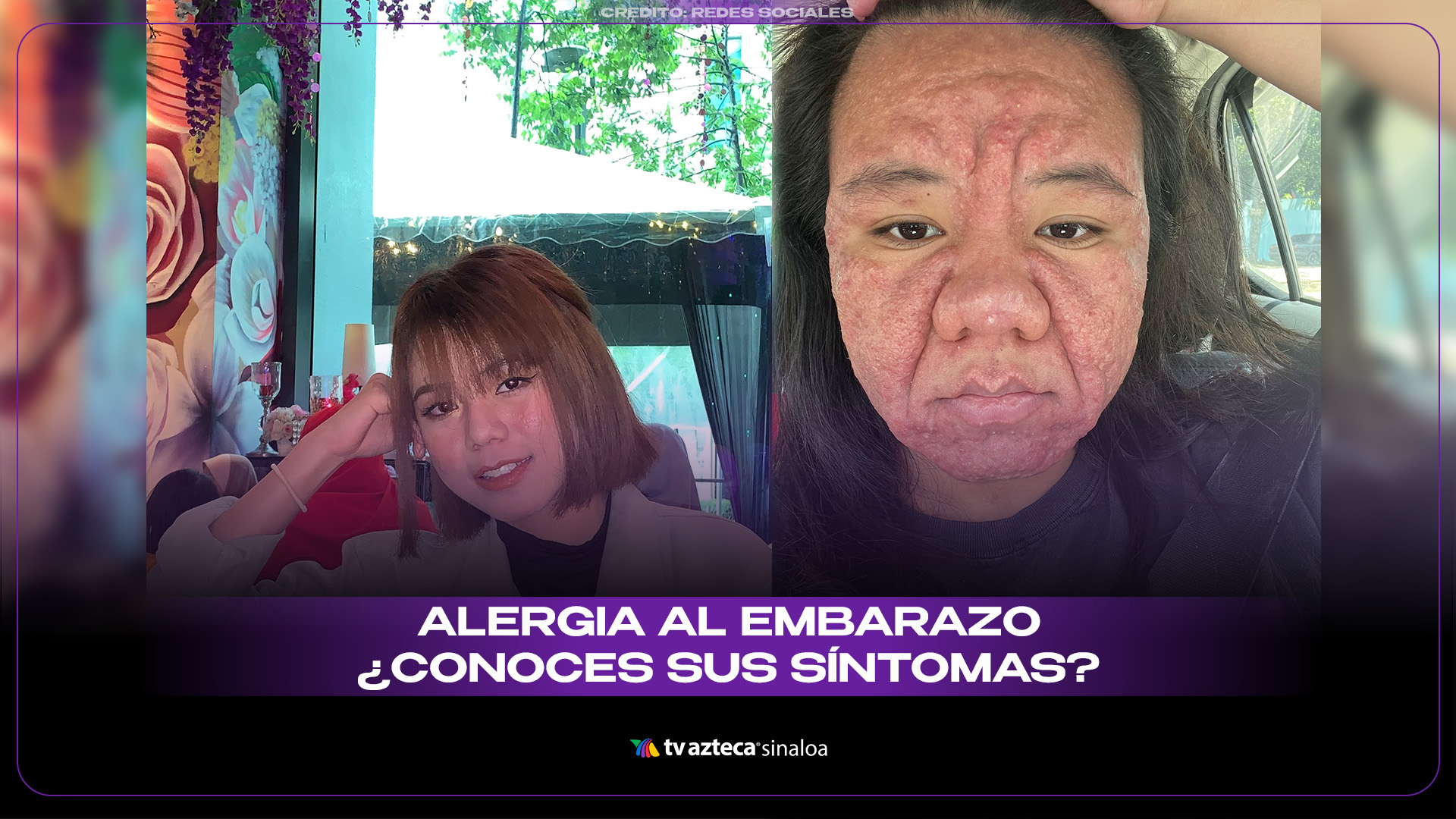 Alergia al embarazo: Lo que debes saber (VIDEO)