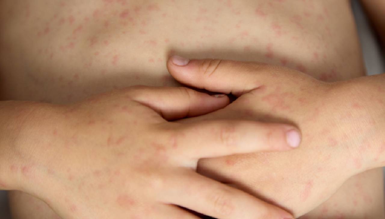 ¿Quiénes se pueden contagiar de escarlatina, cuál es el tratamiento y ...