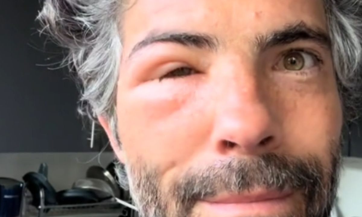 Rostro desfigurado: ¿Qué le ocurrió al actor Osvaldo Benavides?