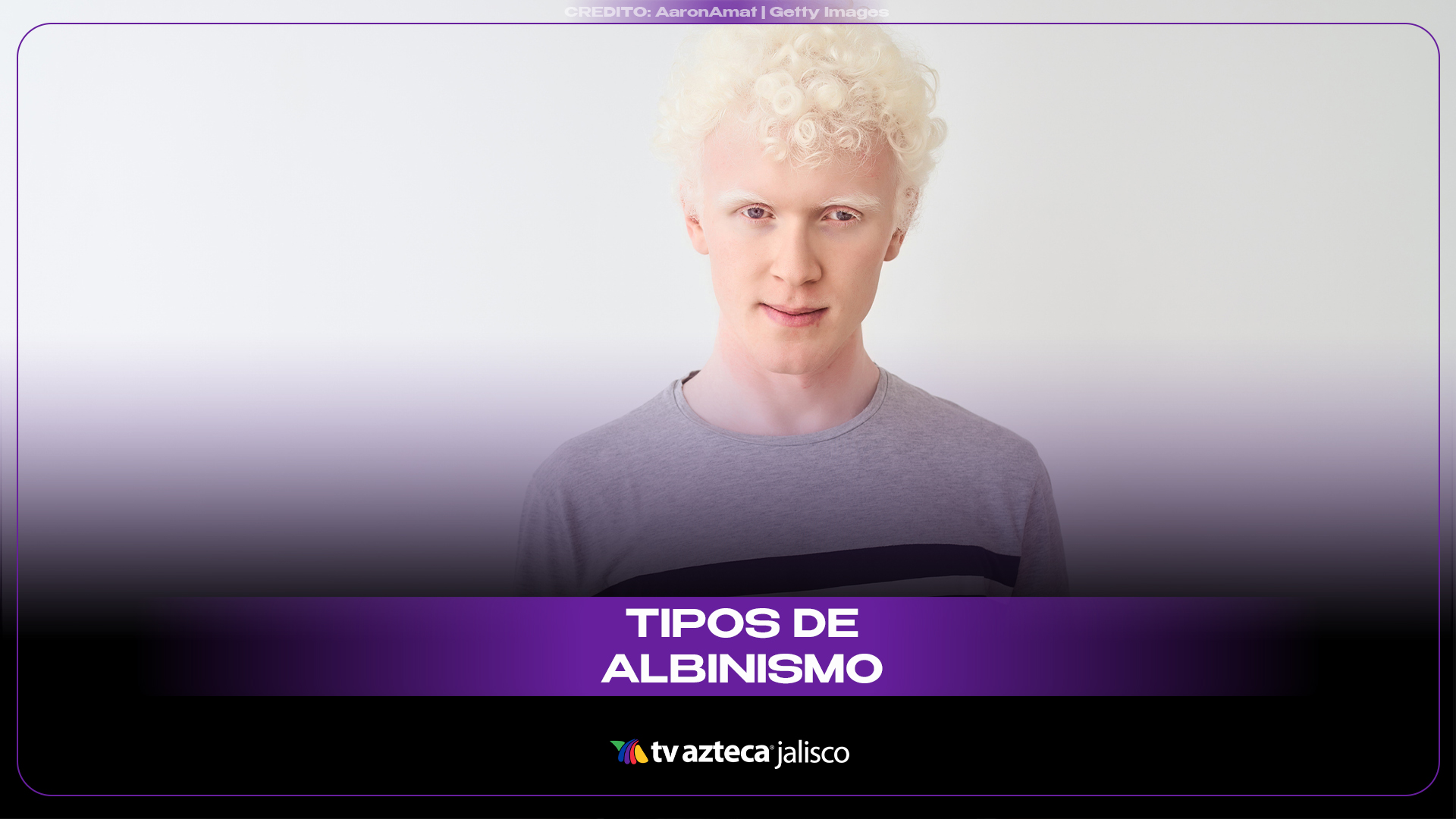 Día mundial del Albinismo: ¿Cuáles son los tipos de albinismo y en qué ...