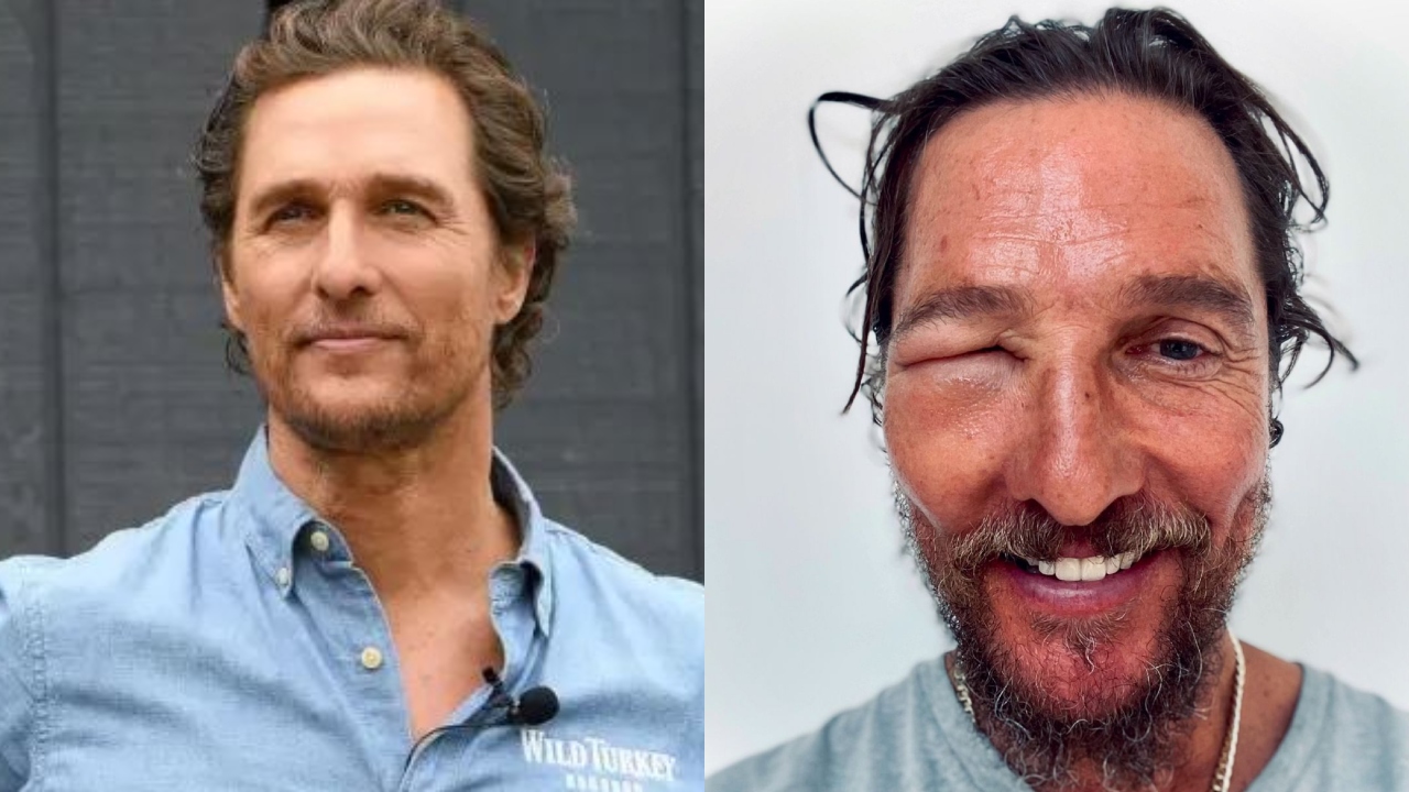 Así luce Matthew McConaughey por piquete de abeja en la cara