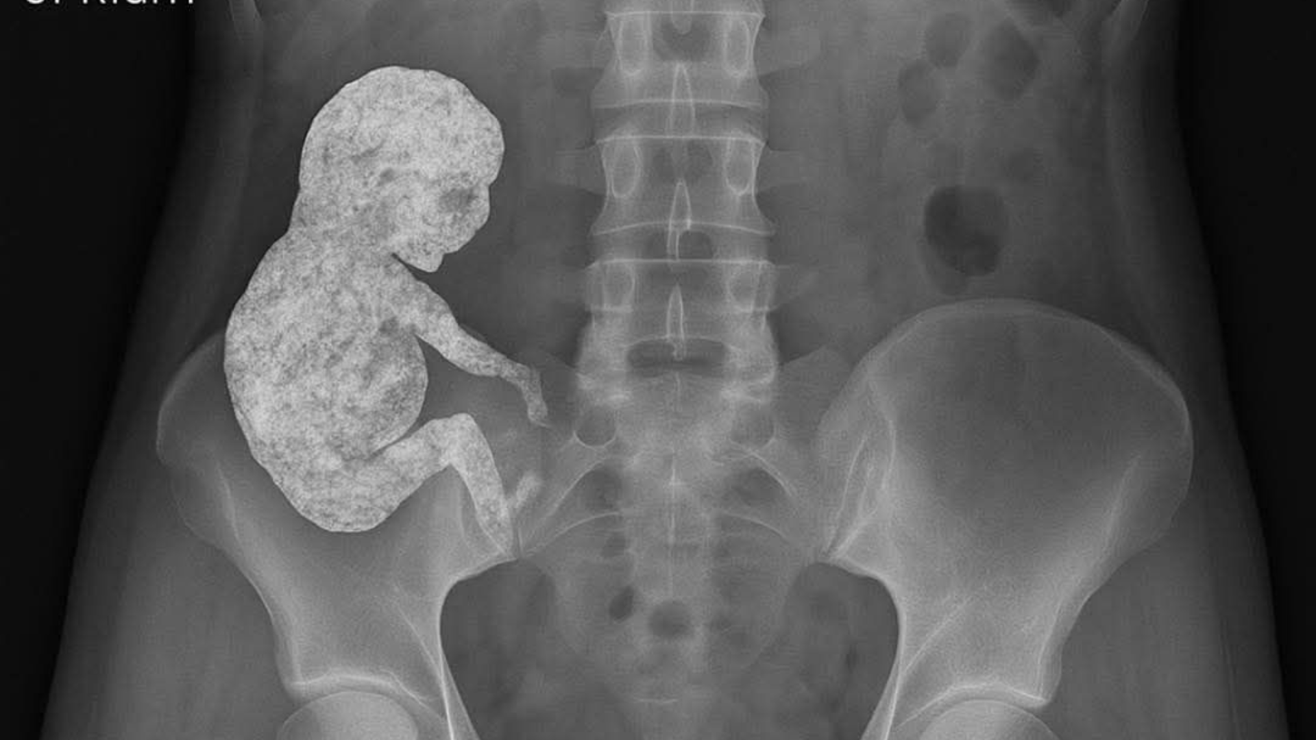 Feto calcificado: Rosa cargó el cuerpo de su hijo no nacido durante 30 ...