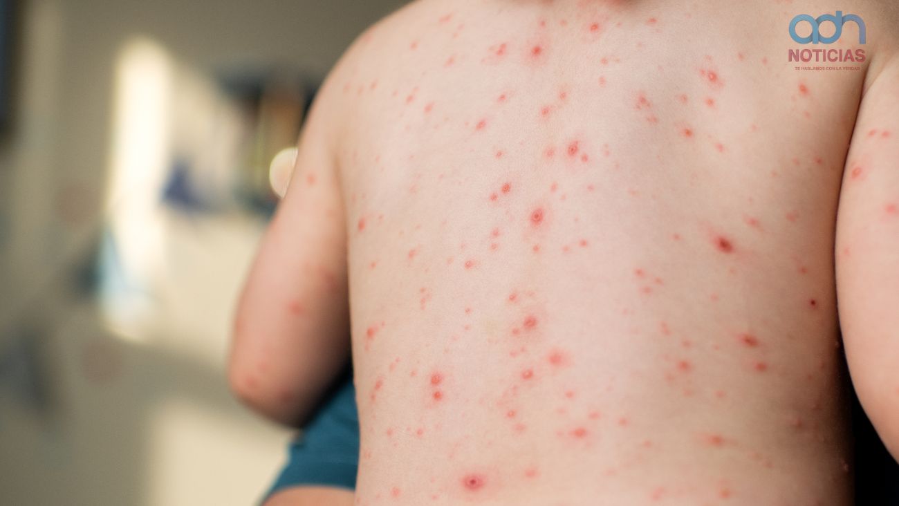 Varicela en México: Estados con más contagios y cuáles son los síntomas