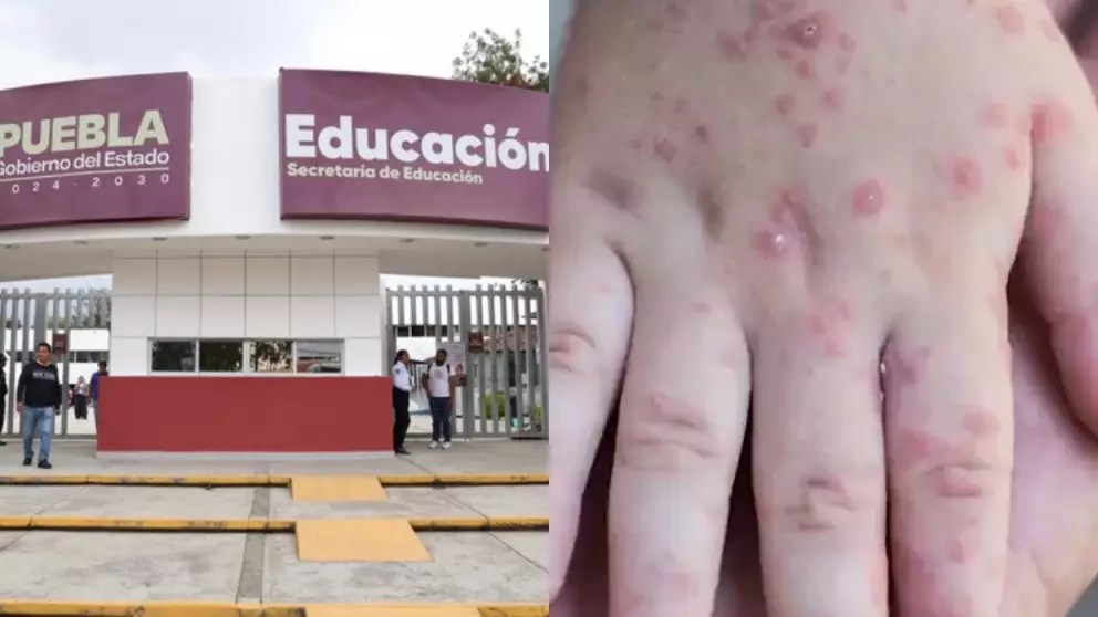 SEP confirma 419 casos de virus Coxsackie en 77 escuelas de Puebla