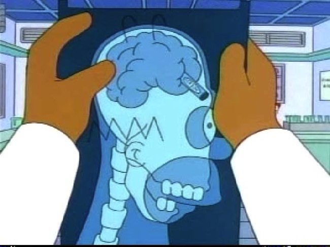 Vivió con lápiz en la cabeza durante 15 años y no es Homero Simpson