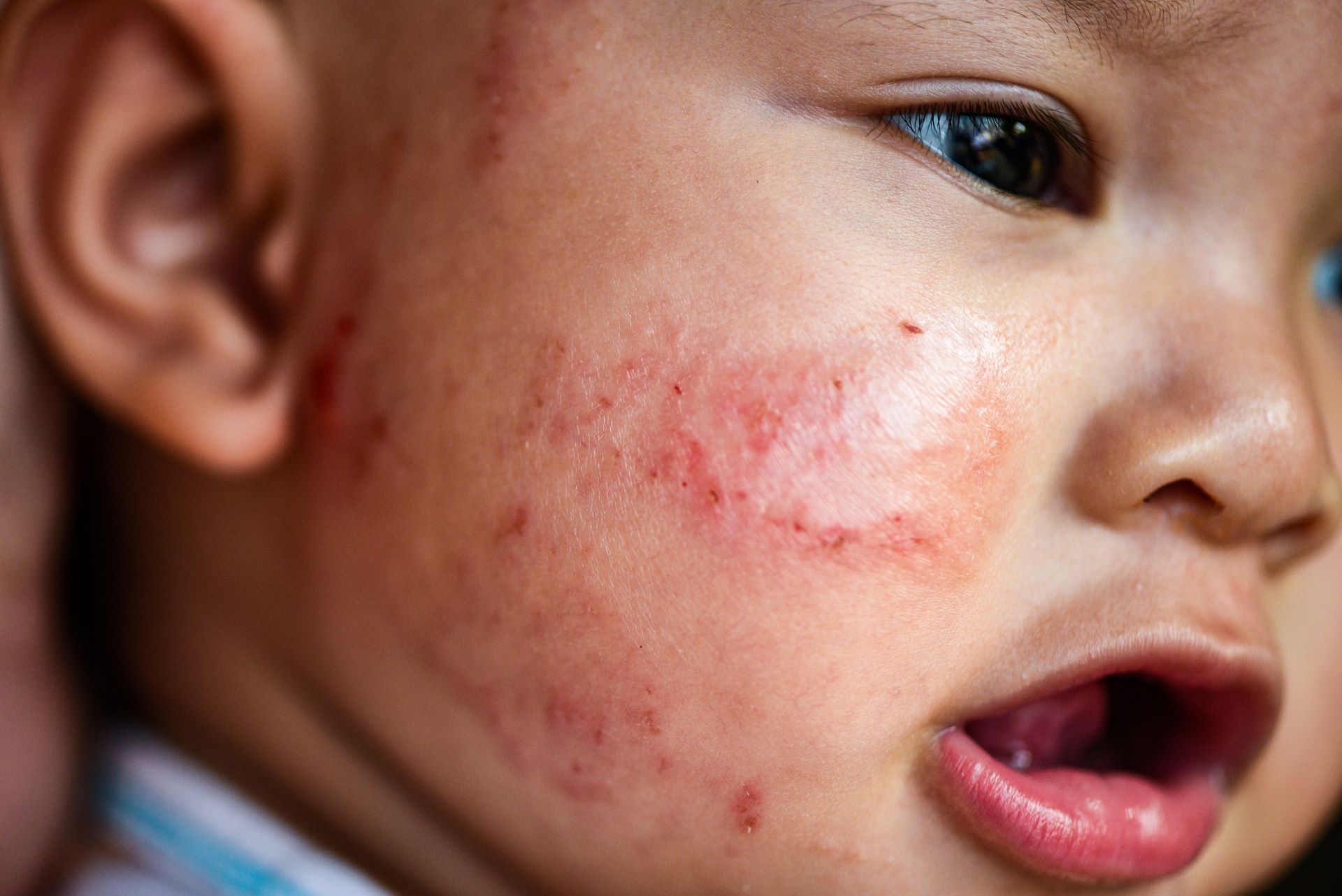 Dermatitis atópica afecta a los bebés desde los primeros meses de vida