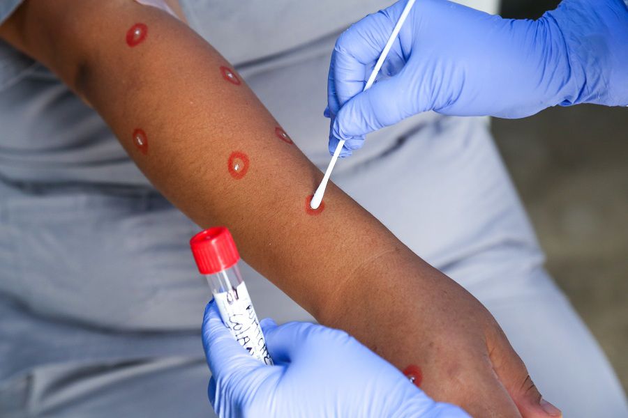 Viruela del mono en México: Oaxaca reporta su segundo caso