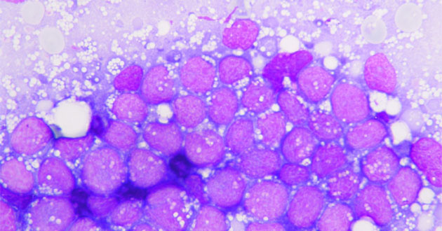 Cáncer en médula ósea