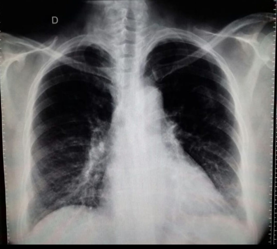 Rayos X De Pulmones De Fumador