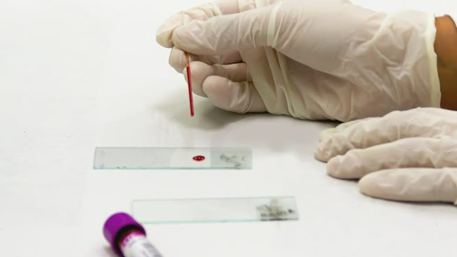 Virus Nipah vuelve a encender alertas sanitarias por su alta mortalidad