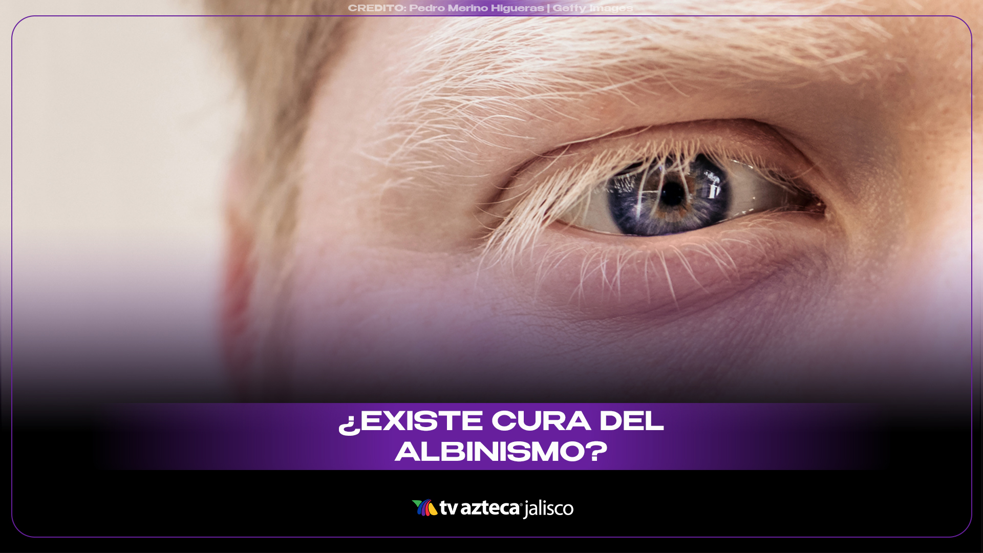 ¿Tiene cura? Este es el tratamiento para el albinismo