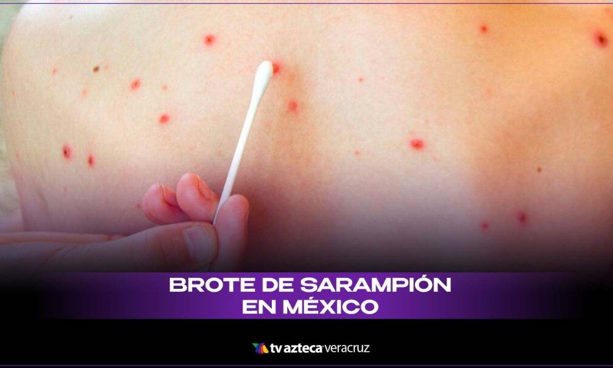Brote de sarampión en México: Alerta sanitaria casi 3 mil casos