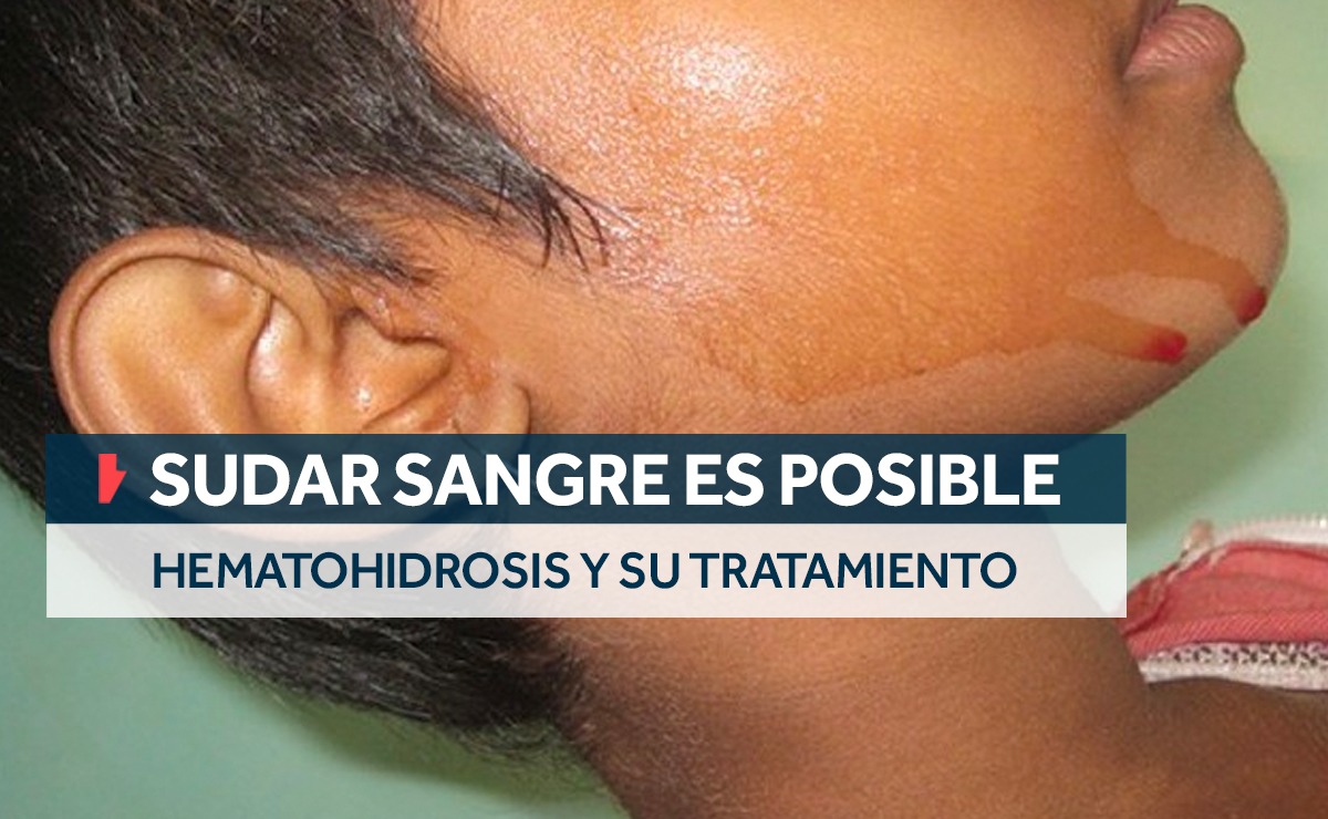 ¿Qué es la hematohidrosis? La enfermedad que te hace sudar sangre