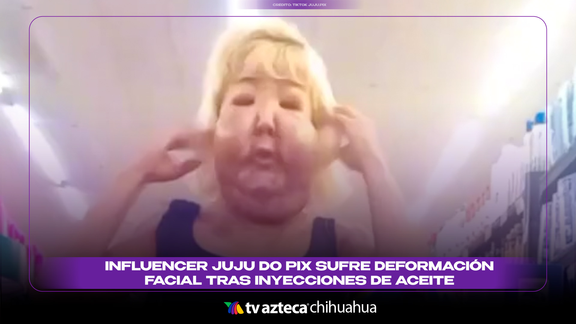 Influencer Juju do Pix sufre deformación facial tras inyecciones de aceite (VIDEO)