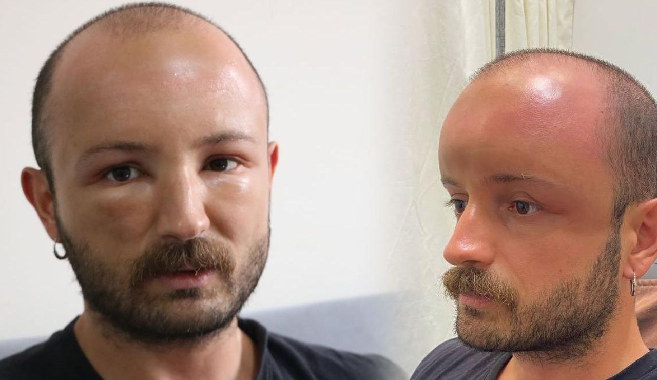 Hombre se le hincha la cabeza por el sol