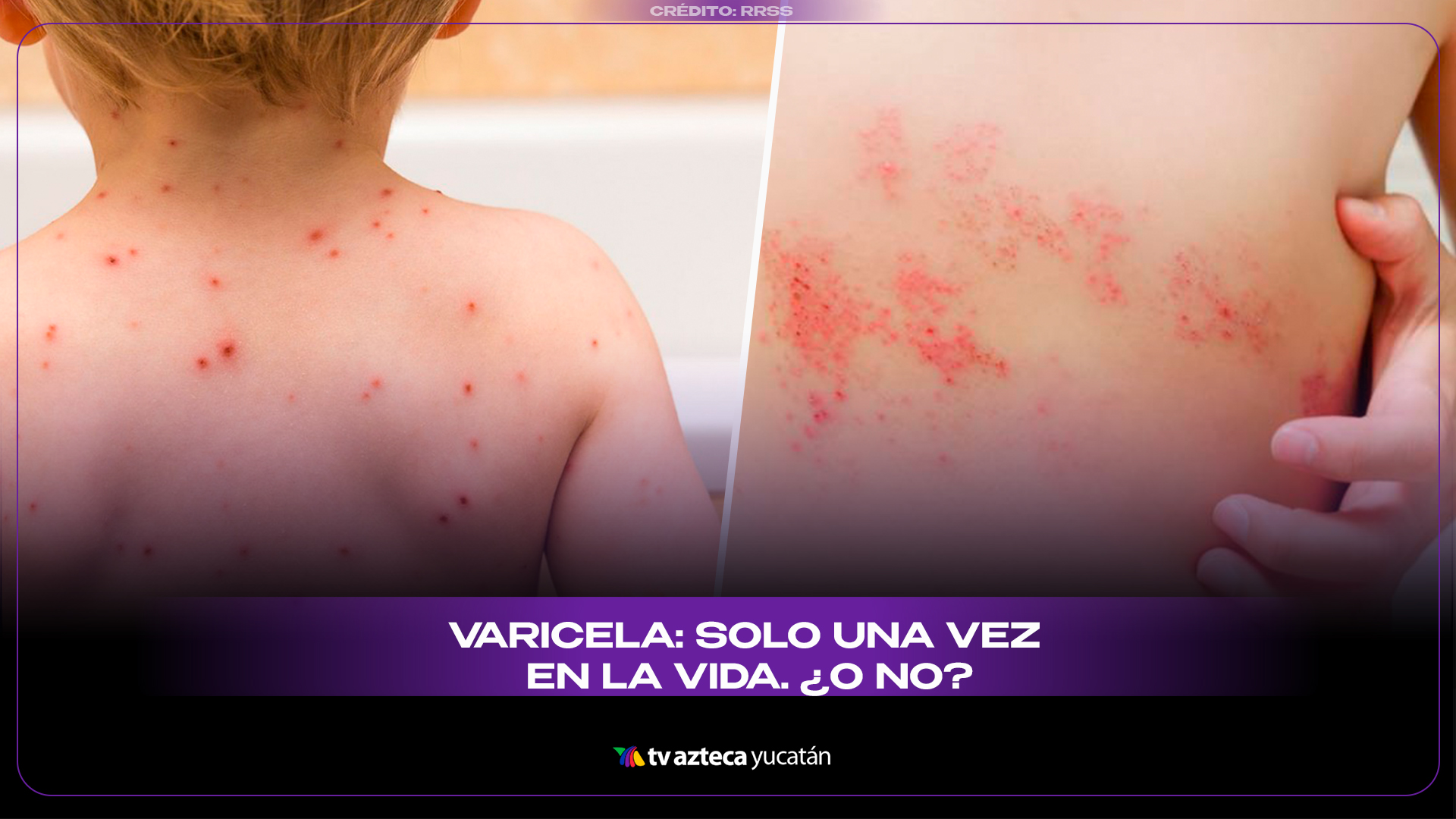 Varicela: ¿por qué solo da una vez en la vida y cómo regresa como ...