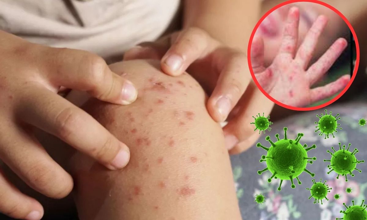 ¿Qué es el virus de Coxsackie registrado en escuelas en Veracruz?