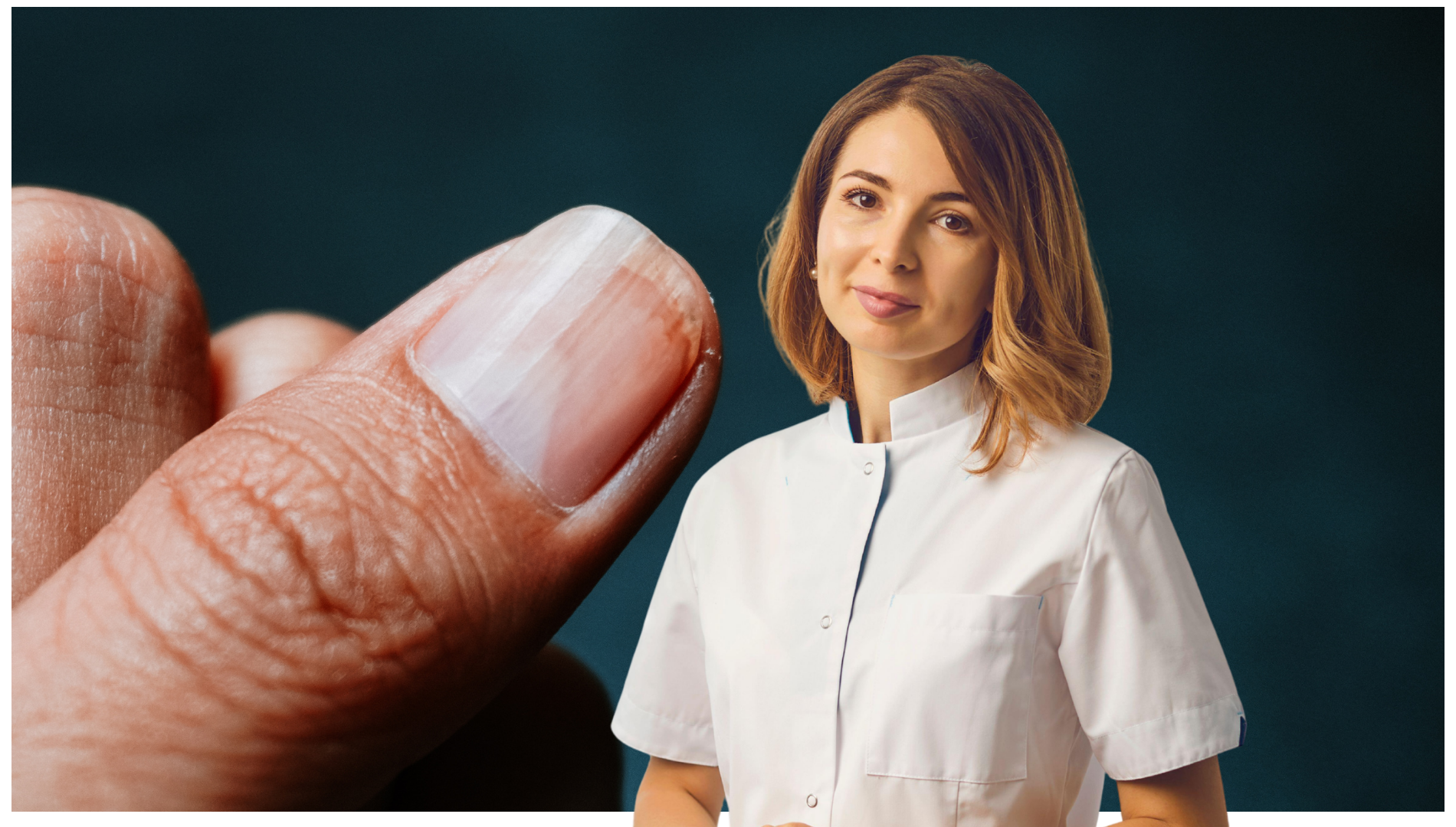 Qué es un melanoma en las uñas y por qué debes preocuparte si te sale
