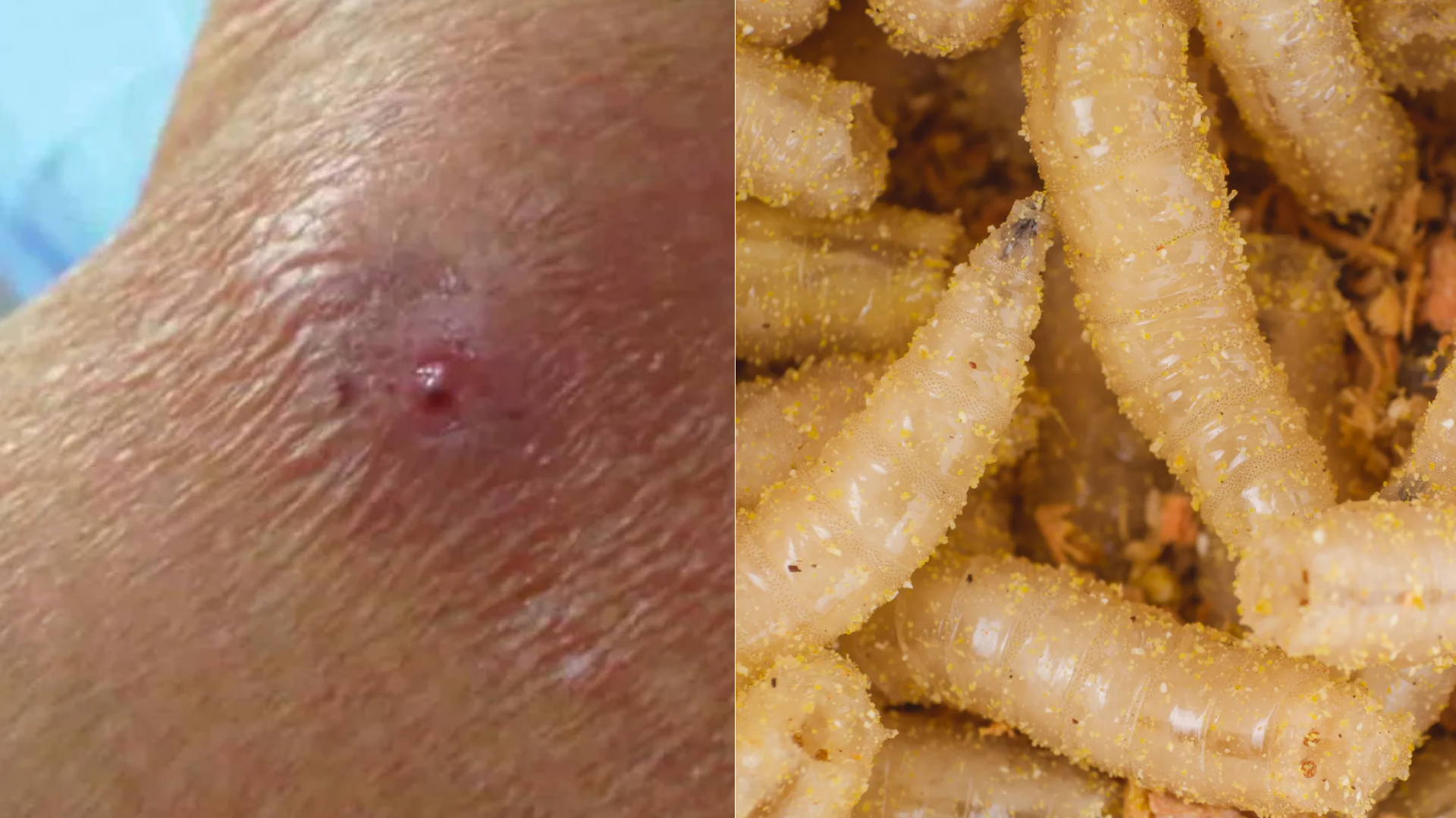 ¡Alerta Sanitaria! Confirman primer caso humano de miasis por gusano barrenador en México