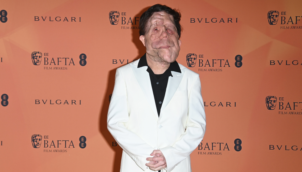 Neurofibromatosis: Cómo es la enfermedad de Adam Pearson, protagonista de Un hombre diferente