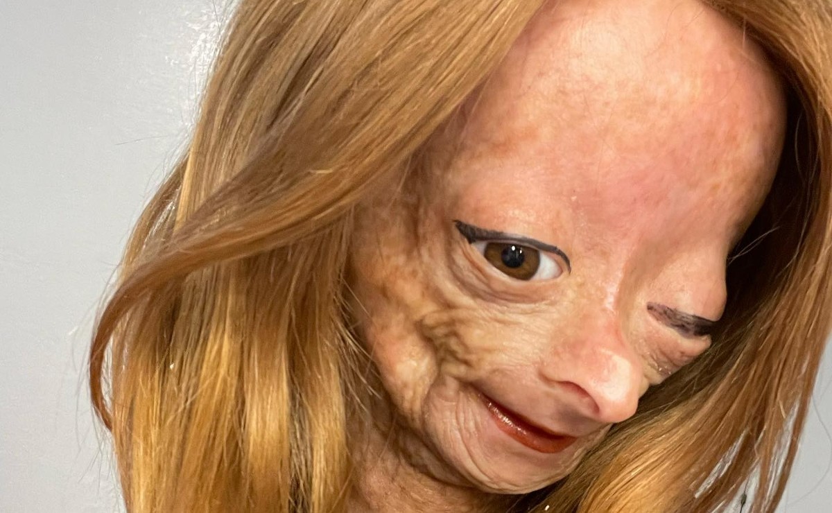 Murió Adalia, joven con progeria o el síndrome de Benjamin Button