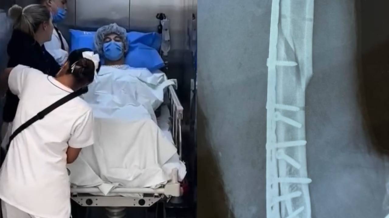 El influencer Sonrix podría perder el brazo por jugar vencidas