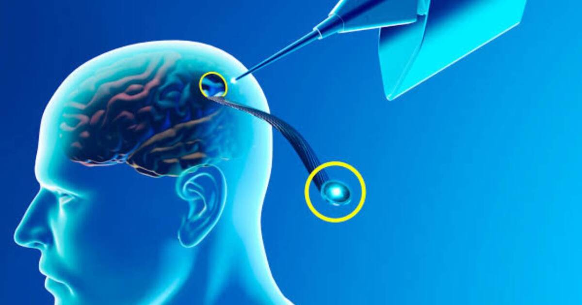 Elon Musk Implanta El Primer Chip De Neuralink En Un Humano