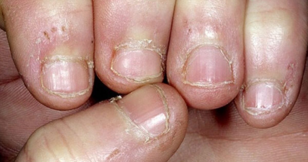 Morderse las uñas provoca deformación de los dedos