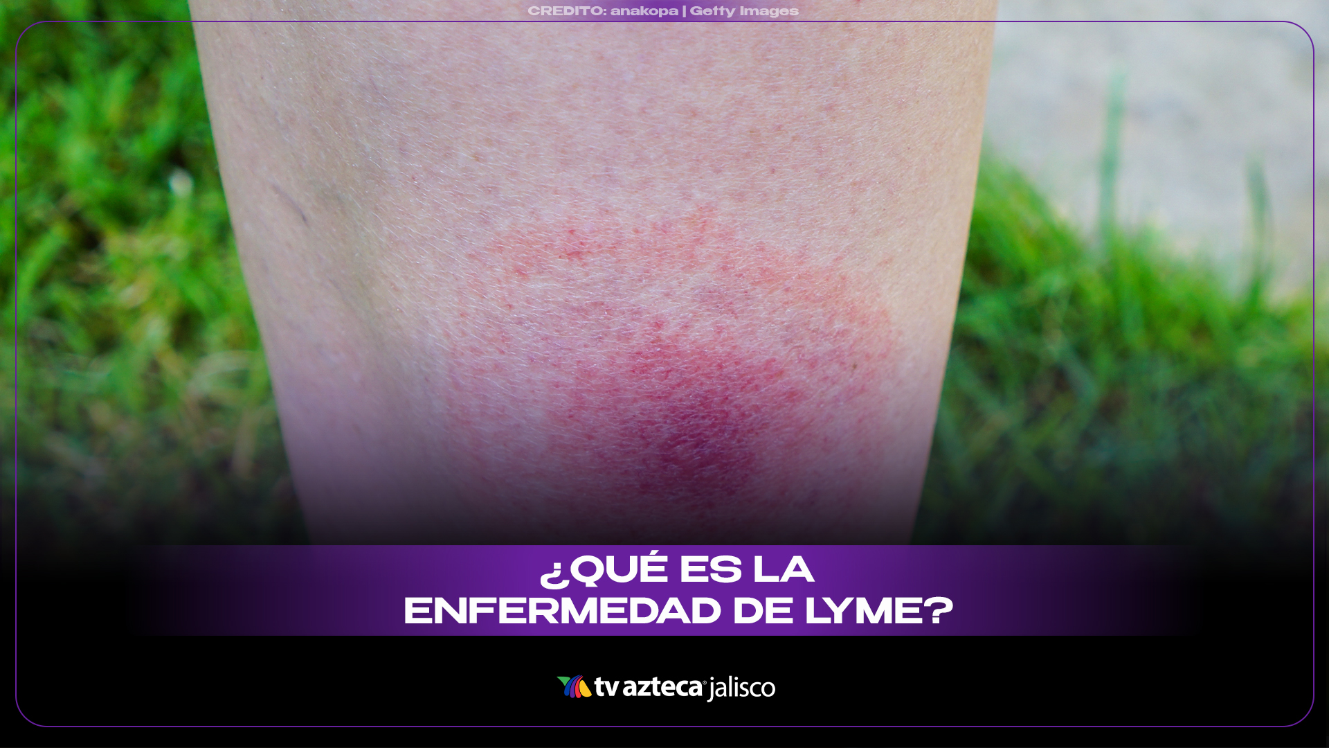 Enfermedad de Lyme: ¿qué es y cuáles son los síntomas?