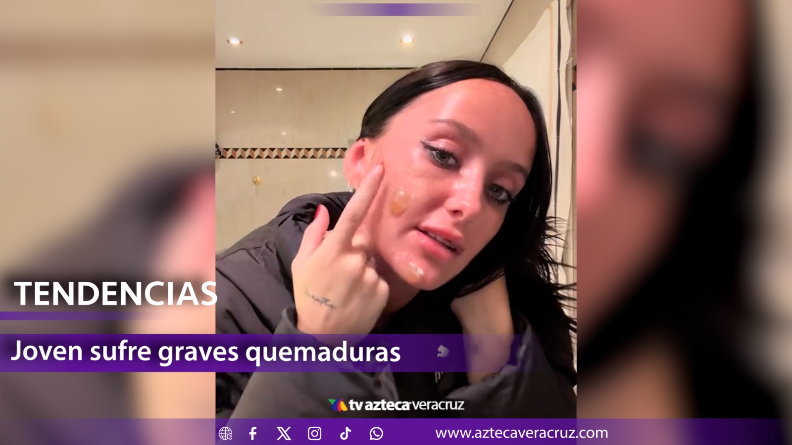 ¿Qué pasó con la mujer quemada en cama de bronceado?