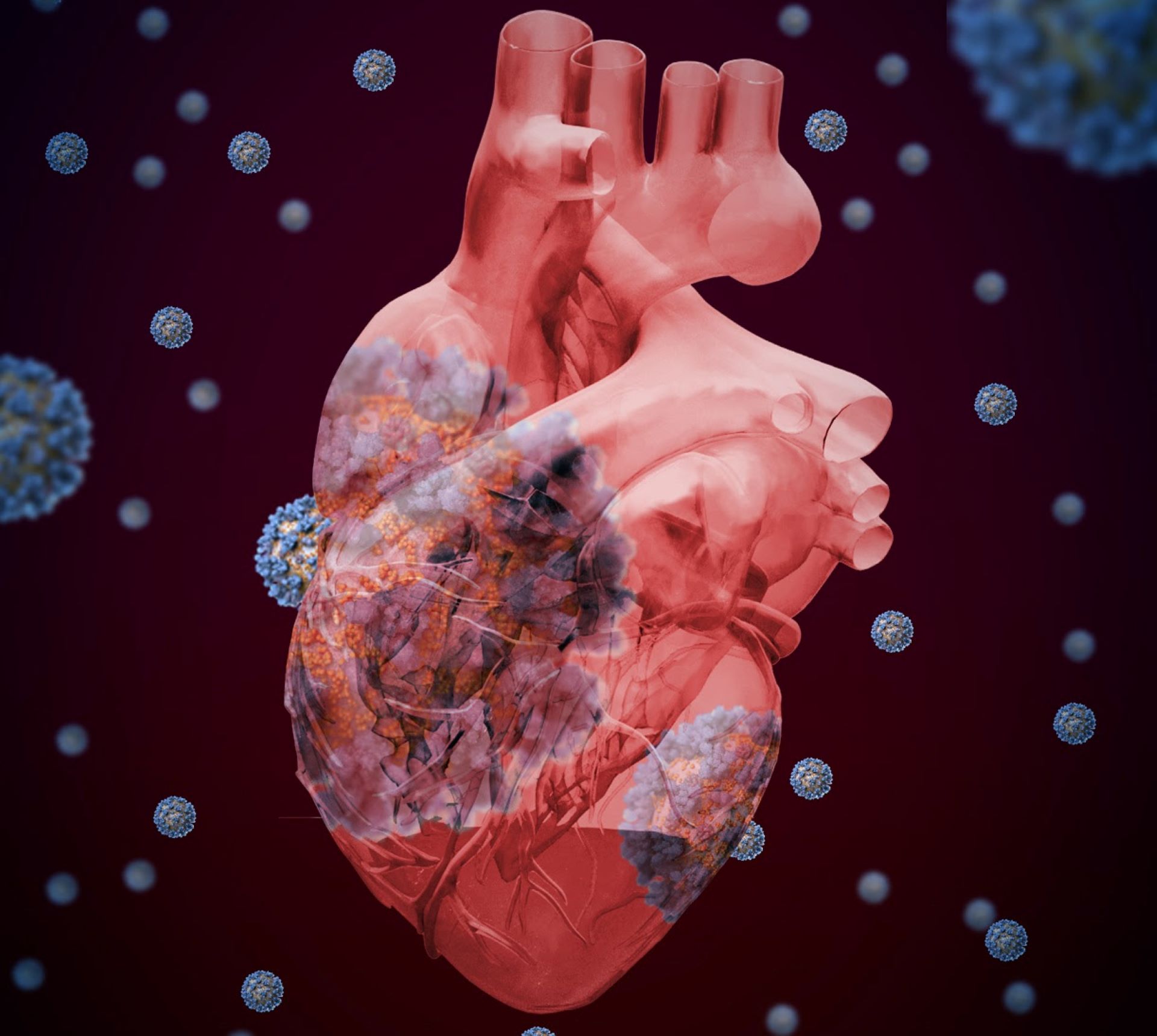 La infección por coronavirus SARS-CoV-2 puede generar lesiones en corazón